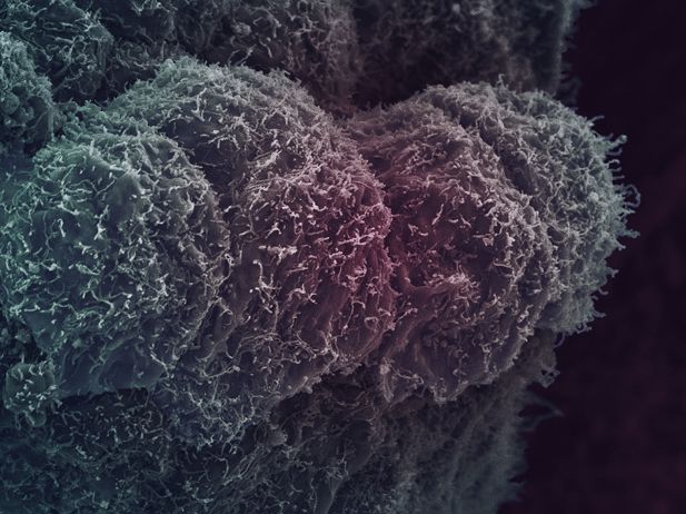 Study finds adding Abiraterone to standard treatment improves prostate ...